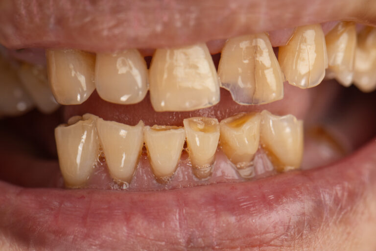Cracked Teeth Treatment in Figtree, NSW | Figtree Dental