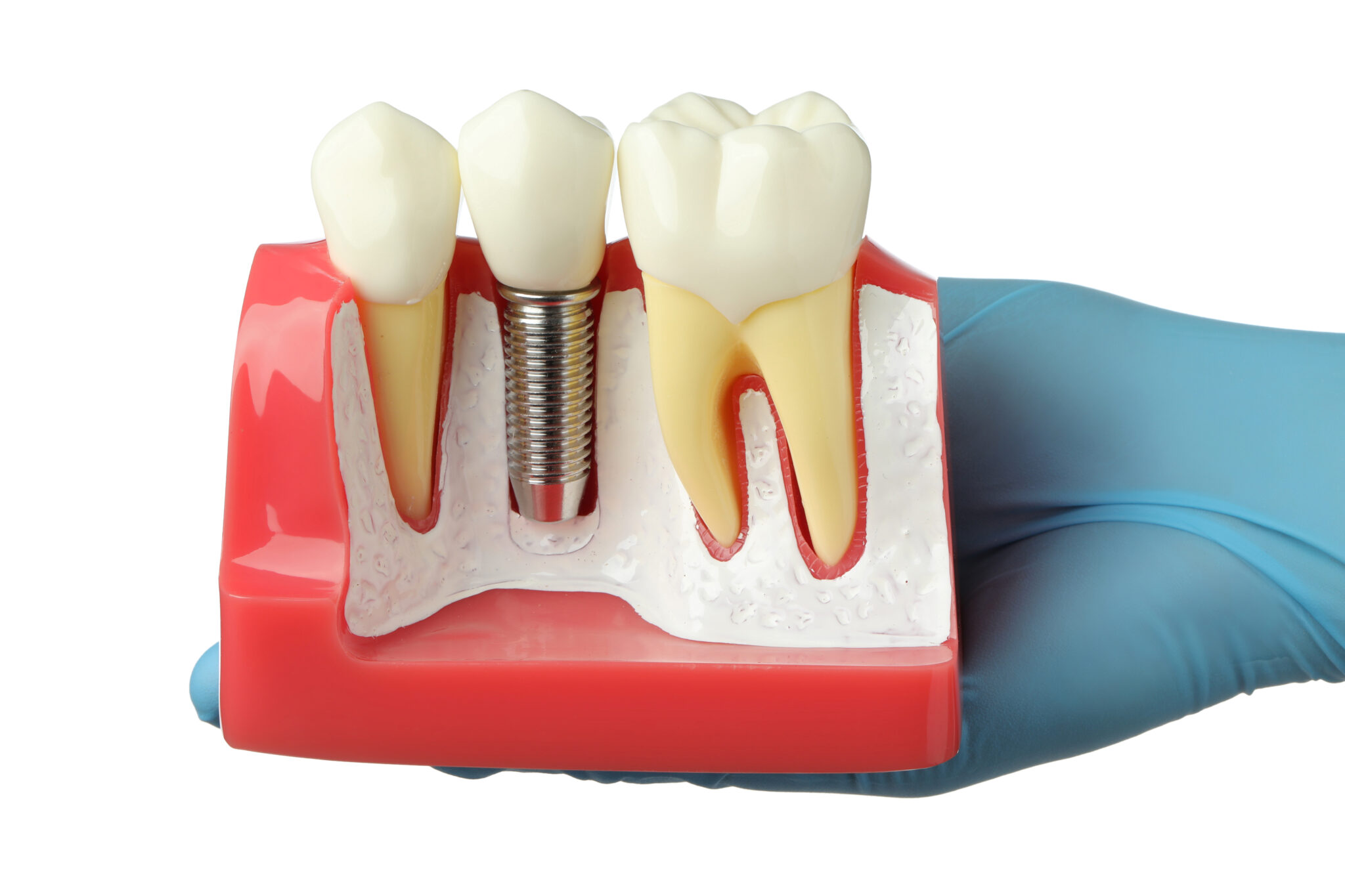 Single Dental Implants in Figtree, NSW | Figtree Dental